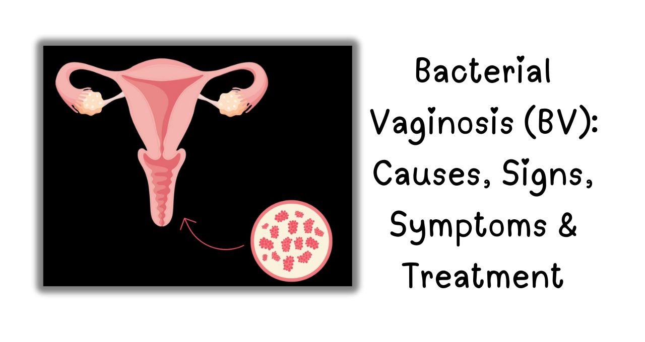 Bacterial Vaginosis (BV): Causes, Signs, Symptoms & Treatment ...