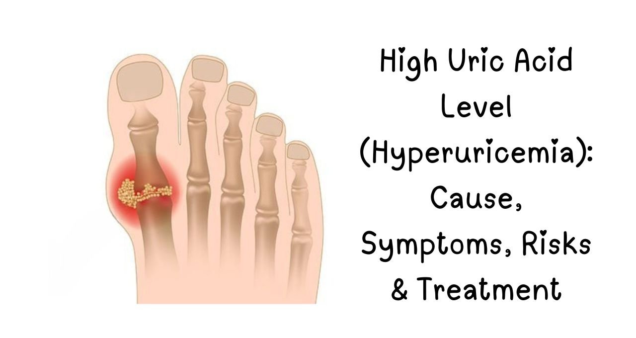 High Uric Acid Level (Hyperuricemia): Cause, Symptoms, Risks ...
