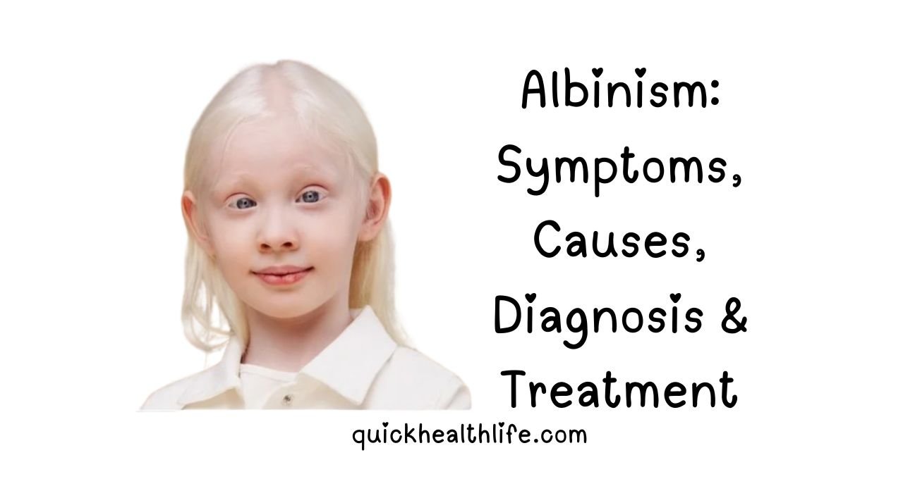 Albinism: Symptoms, Types, Causes, Diagnosis, Treatment, and More ...