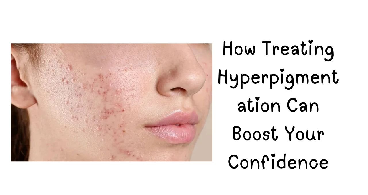 Clear Skin, Clear Mind: How Treating Hyperpigmentation Can Boost Your ...