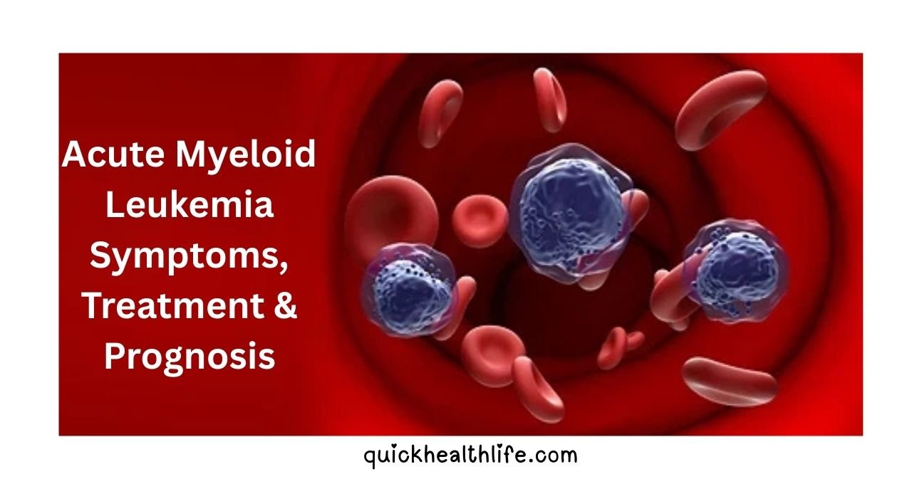 Acute Myeloid Leukemia (AML): Symptoms, Treatment & Prognosis ...