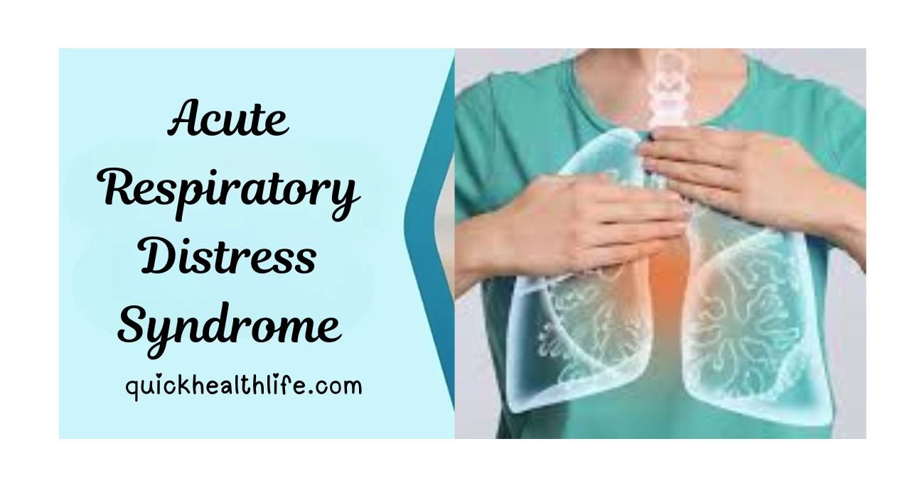 Acute Respiratory Distress Syndrome: Overview, Symptoms, Causes ...