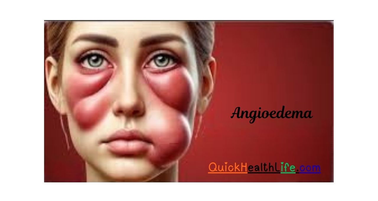 Angioedema: Symptoms, Causes, Diagnosis, Treatment & Best Prevention ...
